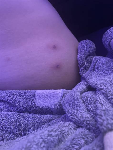 What Is This On My Inner Thigh Rdermatology