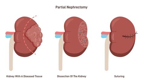 Nephrectomy Neo