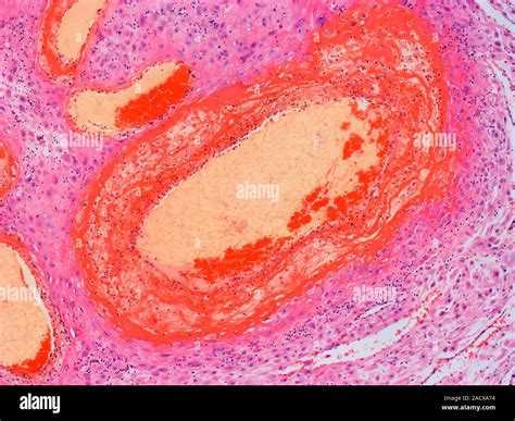 Placental Atherosis Light Micrograph Of A Section Of A Placenta From An Emergency Caesarean
