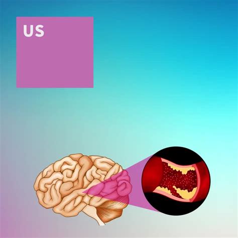 Science Diffusion On Linkedin Stroke Is A Leading Cause Of Disability