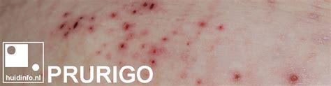 Prurigo Info Van De Dermatoloog