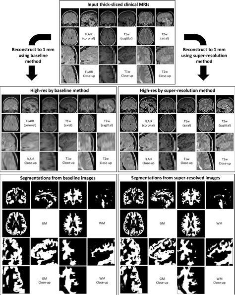 Figure From A Tool For Super Resolving Multimodal Clinical MRI Semantic Scholar