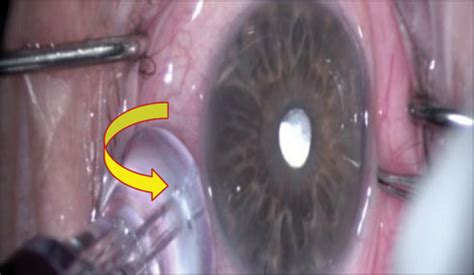Micropulse Transscleral Diode Laser Cyclophotocoagulation An Option For