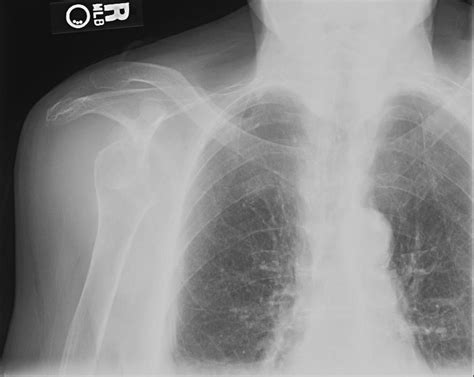 Anterior Shoulder Dislocation Orthopedics Medbullets Step 2 3