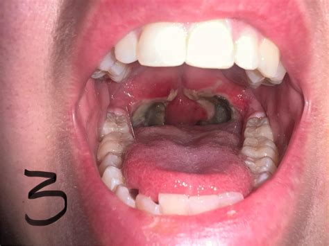 Tonsillectomy Recovery With Pictures Rtonsilstones