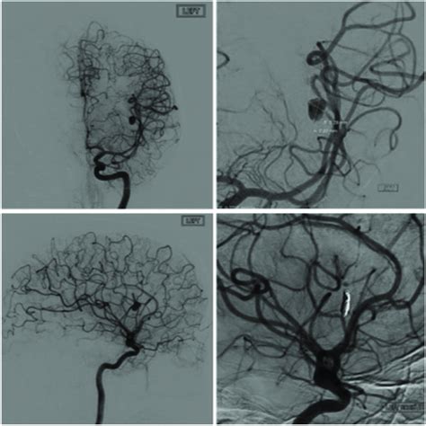 Diagnostic Cerebral Angiogram Showing Left Distal Middle Cerebral