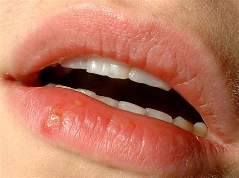 Herpes Labialis Doccheck