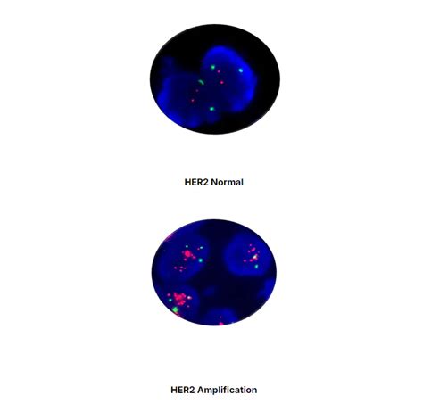 How Do We Know If Her2 Breast Cancer Is Positive