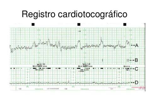 Monitorización Fetal Intraparto