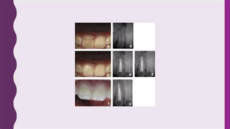 Apexogenesis And Apexification Pptx