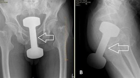 Viral Foto Rontgen Pria Amerika Kemasukan Barbel Di Duburnya Dikira Di