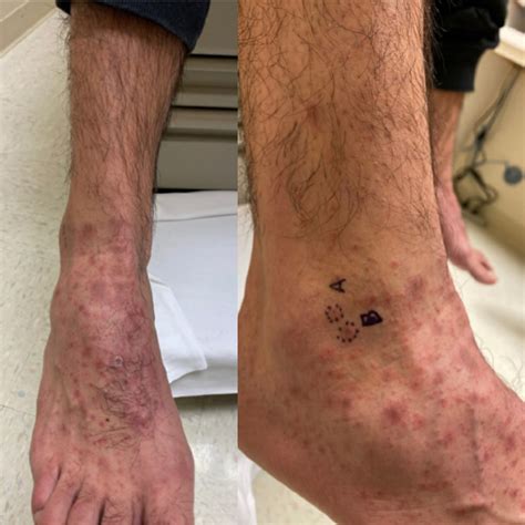 Gloves And Socks Syndrome Icd 10 At Gemma Dalton Blog