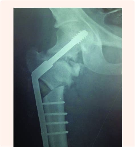 Immediate Post Operative Radiograph Download Scientific Diagram
