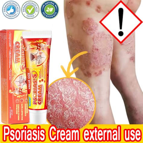 Ointment For Psoriasis Vulgaris At Crystal Frasher Blog