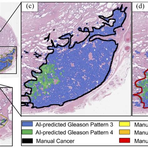 The Ai Predicted 60 Automated Aggressive Gleason Pattern 4 Green And Download Scientific