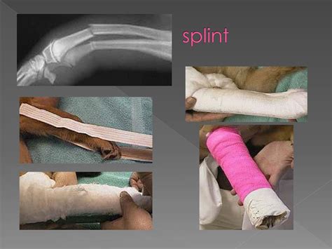 Ppt Fractures Powerpoint Presentation Free Download Id2133433