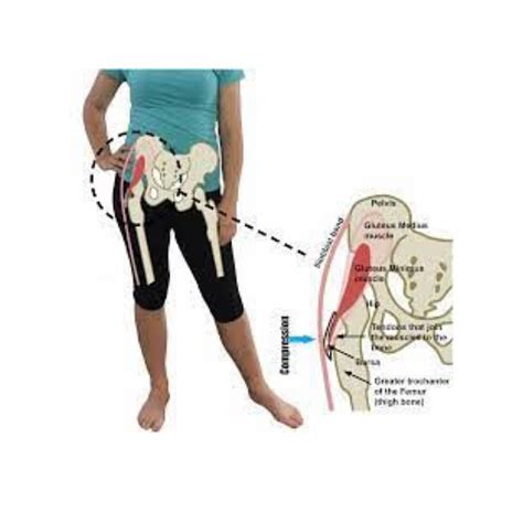 Lateral Hip Pain
