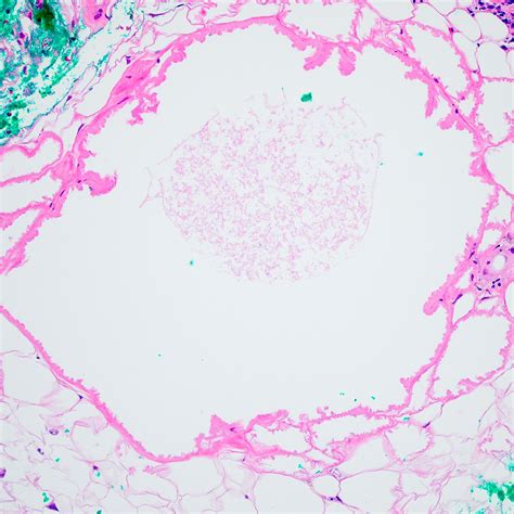Pathology Outlines Lipodermatosclerosis