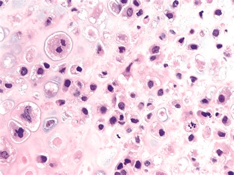 Chondrosarcoma Histology