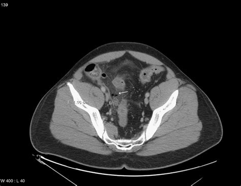 The Appendix On Ct Clinical Radiology