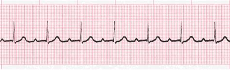 Heart Block Rhythms