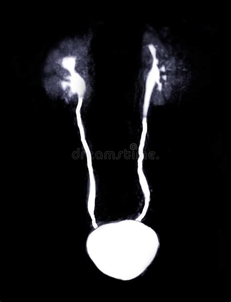 Magnetic Resonance Urography Mr Urography Stock Image Image Of
