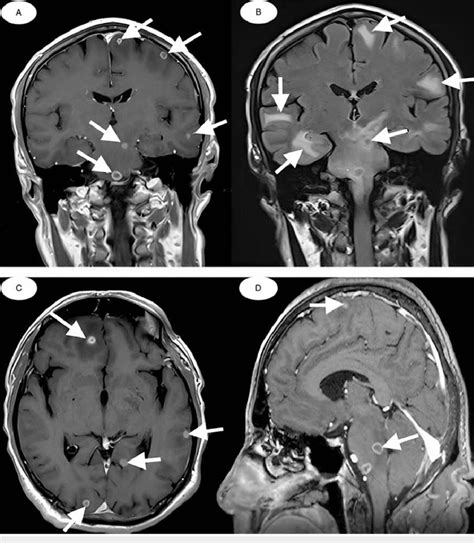 Ct Brain Anatomy Normal Brain Ct And Anatomy