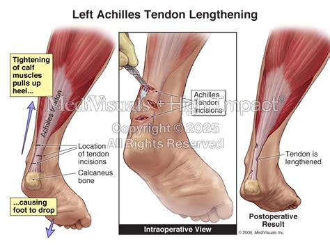 Left Achilles Tendon Lengthening