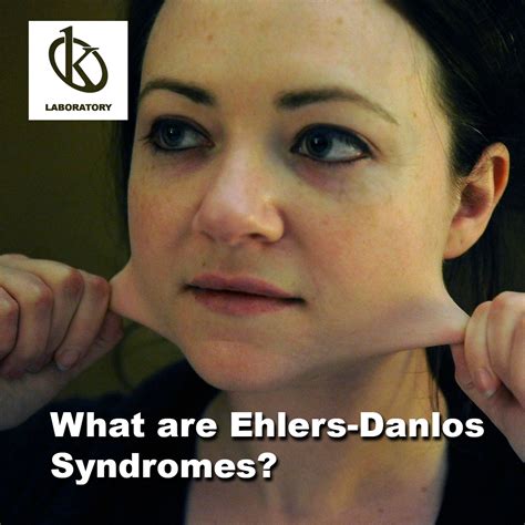 What Are Ehlers Danlos Syndromes Kalstein France