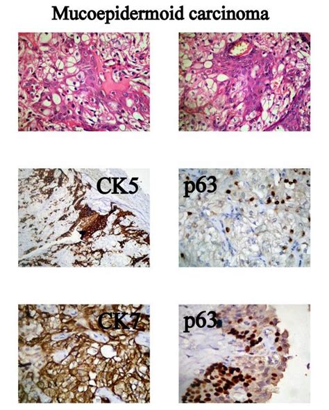 Mucoepidermoid Carcinoma Welcome To Qc Mark