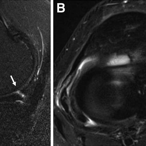 Preoperative Magnetic Resonance Imaging Mri Of Ramp Lesion In Right