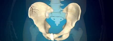 Todo Sobre La Fractura De Pelvis Guia Tu Cuerpo