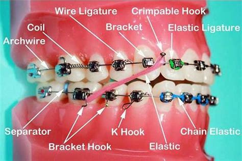 Kesan Getah Braces Tercabut Verde Amani Dental Care