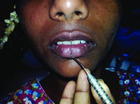 Moderately Arched Type Of Lip Form Download Scientific Diagram