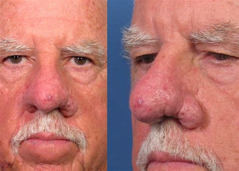 Rhinophyma Of The Nose Treatment And Surgery In San Diego Ca Dr