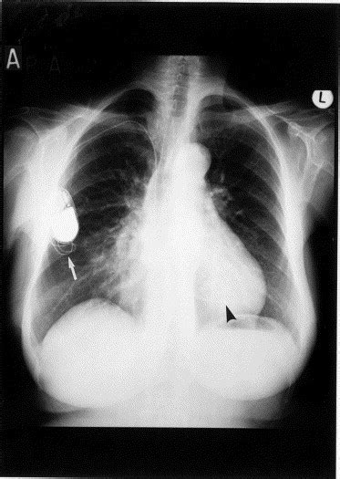 Pacemaker And Defibrillator Twiddlers Syndrome European Journal Of