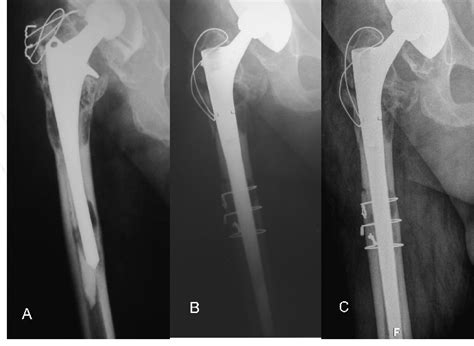 Cementless Revision Of Paprosky Type 3a Defect With A Modular Tapered