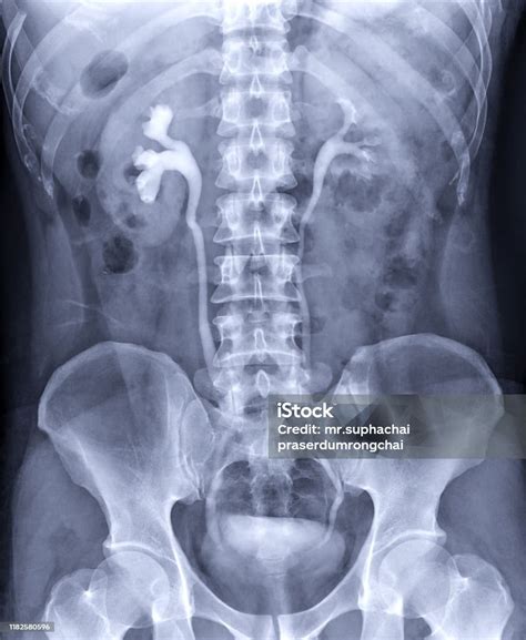 Intravenous Pyelogram Or Ivp Is An Xray Exam Of Urinary Tract After