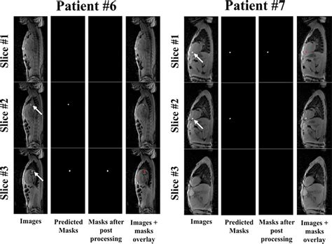 the complete reconstruction pipeline shown for patients 6 and 7 here
