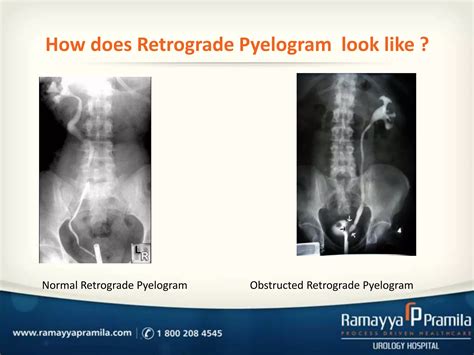 Antegrade And Retrograde Pyelography Pptx Medical Tests Medical Health Antegrade And Retrograde Pyelography Pptx Medical Tests Medical Health