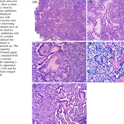 On Nasendoscopy A Well Defined 1 Cm Large Polypoidal Tumor Was Seen