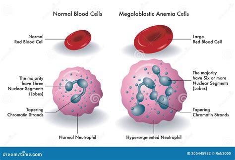Blood Cells With Megaloblastic Anemia Stock Vector Illustration Of
