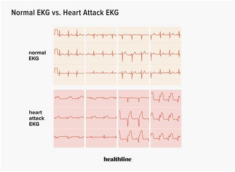 Heart Attack Ecg