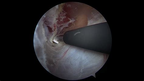 Pec Minor Tenotomy Is This Surgery Right For You 2024 Guide Wiki Science Blog