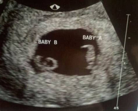 Ultrasound Pictures Of Identical Twins High Risk Identical Twin
