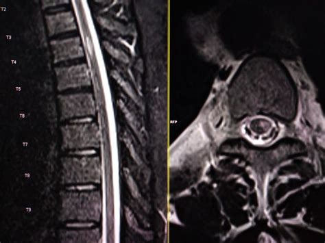 Plaque Of Multiple Sclerosis