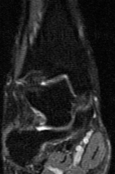 Fourier Transform How Can A Frequency Specific Interference In Mri Be