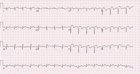Pathological Q Wave Standardised Criteria For Ecg Interpretation In Athletes