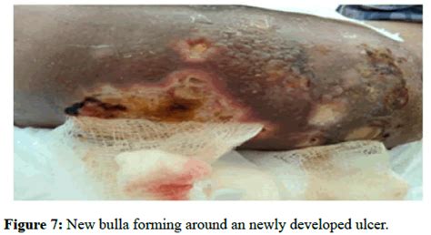 Bullous Pyoderma Gangrenosum Rare Association A Case Report And