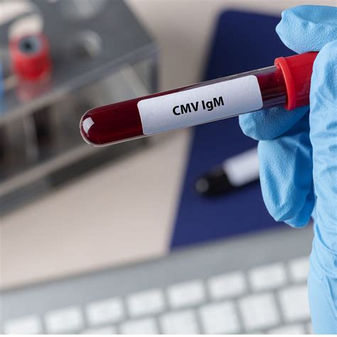 Cmv Igm Cmv Igm Nedir Cmv Igm Negatif Ve Pozitif Nedir Güvenli Test